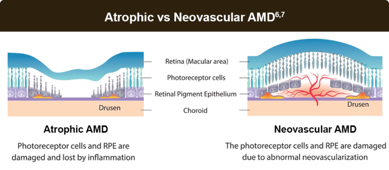 Pathophysiology of AMD: Vision Loss Information | Vision RELIEF